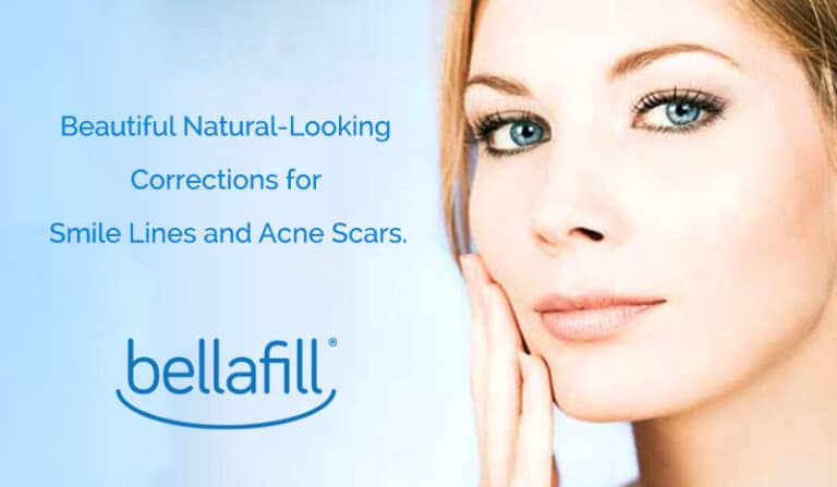 The Benefits of Bellafill | Mao Facial Plastics
