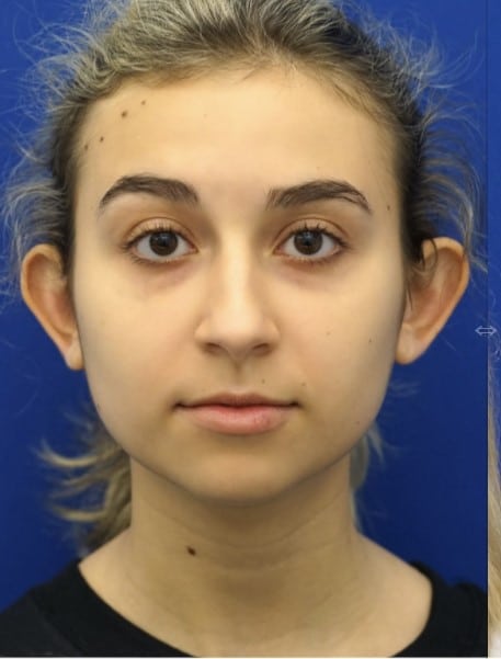 Ear Surgery in Orange, CT | Otoplasty | Ear Reshaping Specialist