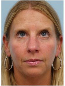 BOTOX® Cosmetic in Orange, CT | Mao Facial Plastic Surgery